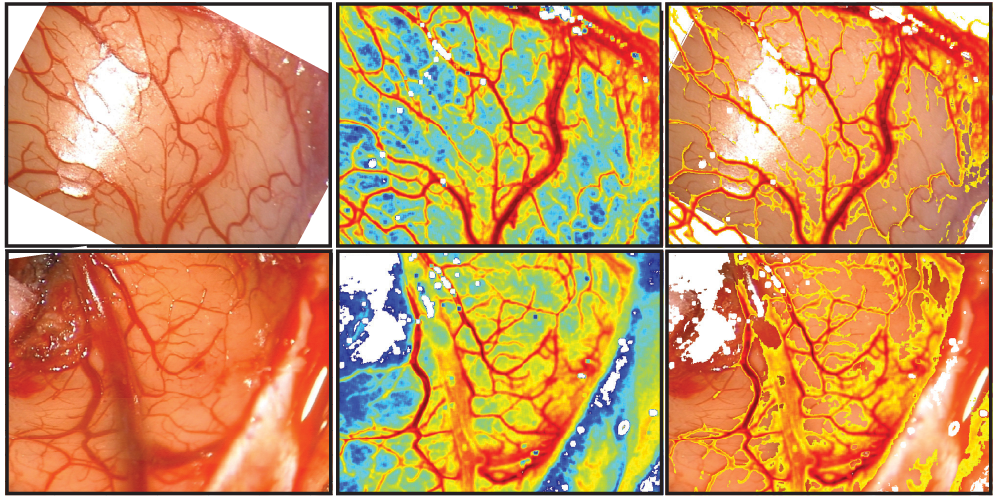 Clinical Speckle Imaging | Functional Optical Imaging Laboratory